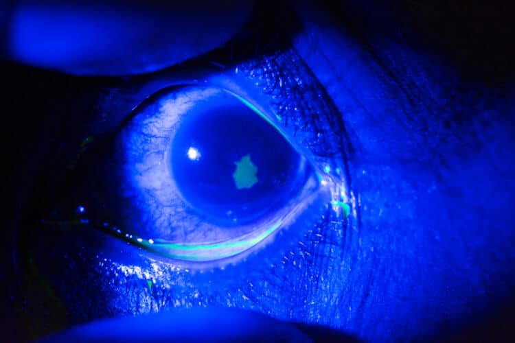 Corneal Abrasions Hinsdale | Cornea & External Disease Wheaton