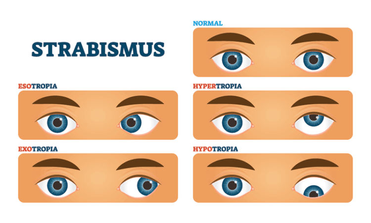 Pediatric Strabismus St. Charles | Pediatric Eye Exam Wheaton, IL