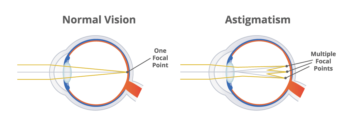 Astigmatism Hinsdale | Pediatric Ophthalmology Wheaton, IL