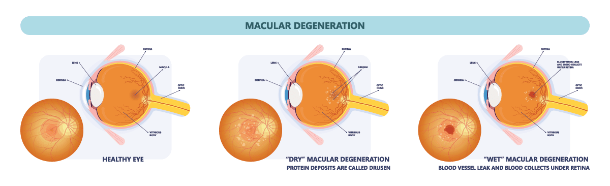 Macular Degeneration Diagram